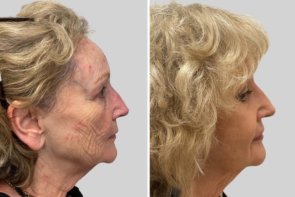 The Ultimate Guide to Phenol Peels: What to Know | Beautifi